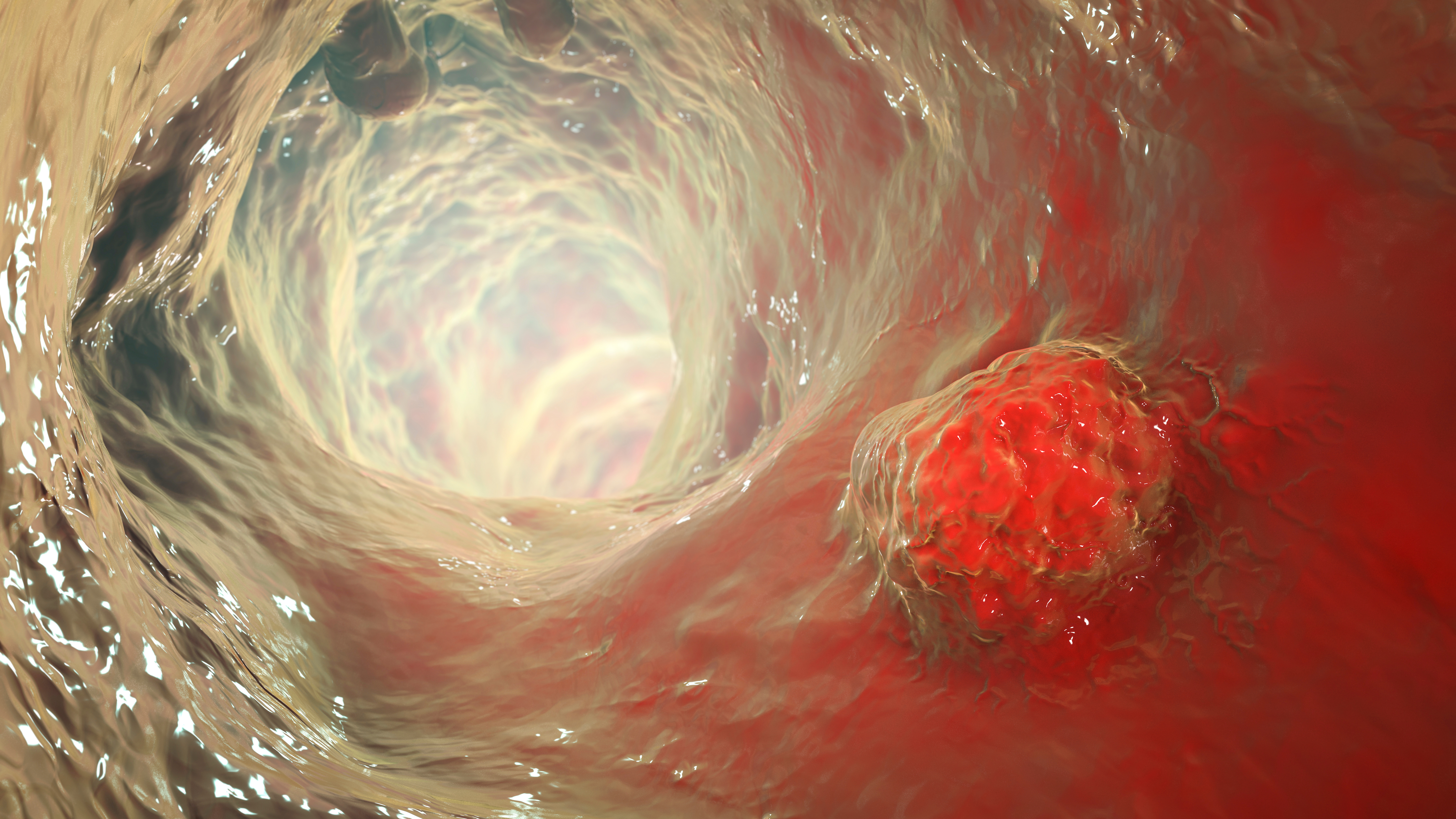 GI and Hepatology News - Atezolizumab boosts colon cancer disease free ...
